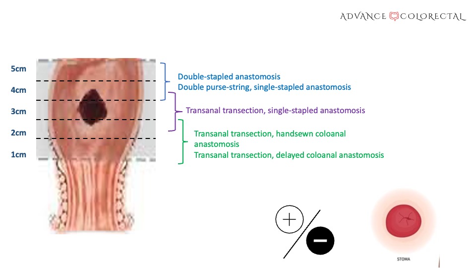 The Coloanal Anastomosis