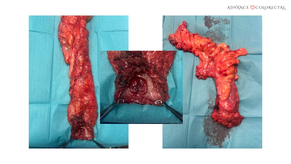 The Coloanal Anastomosis